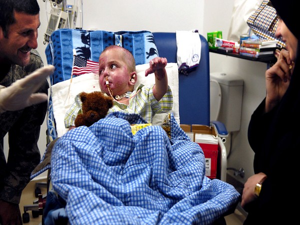 Cool running water best first aid for burns in children: Study