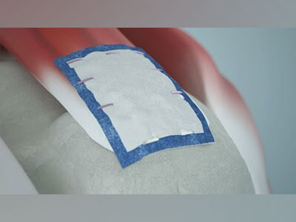 Smith+Nephew launches REGENETEN Bioinductive Implant in India for ...