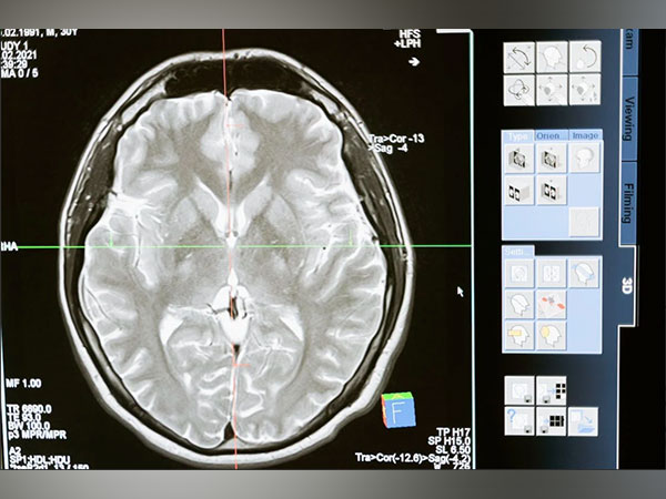 Monitoring brain waves could reduce post-op complications: Study