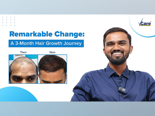 Unlock Your Confidence with VCare's Revolutionary Hair Regrowth Solution!