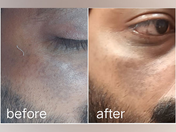 Over 80 per cent of Indian Women Affected by Melasma and PIH, Experts ...