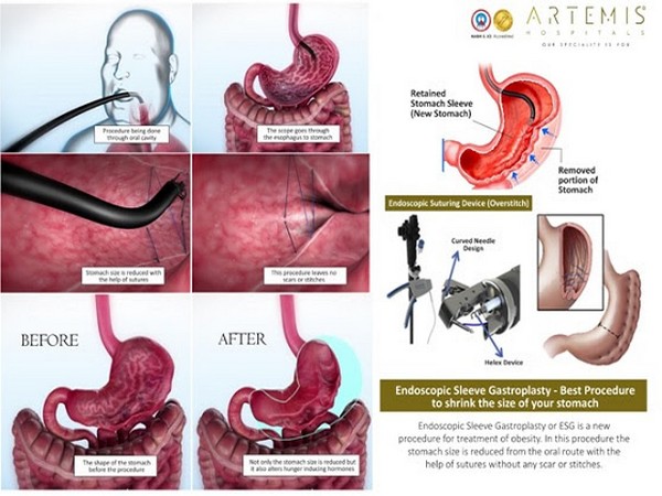 Artemis Hospital performs North India's first Endoscopic Sleeve ...
