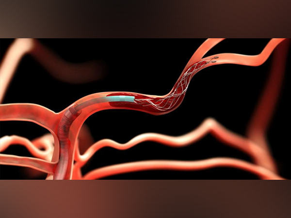 Medtronic commences PRAAN, India's first-ever clinical registry to ...