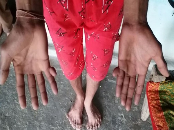 This MP family members have 12 fingers in hand and feet