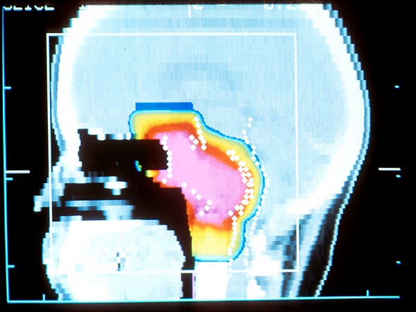 Proton Therapy For Cancer Significantly Reduces Risk Of Severe Side Effects As Against