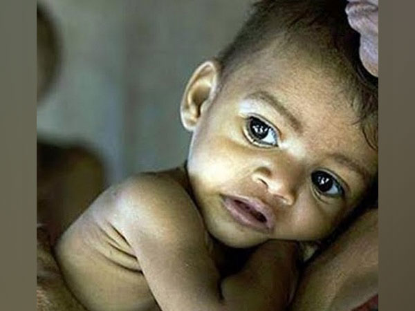 Identification of SAM children a timely move; community management ...