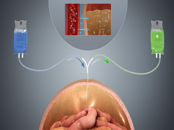 Wearable artificial kidney may improve peritoneal dialysis: Study